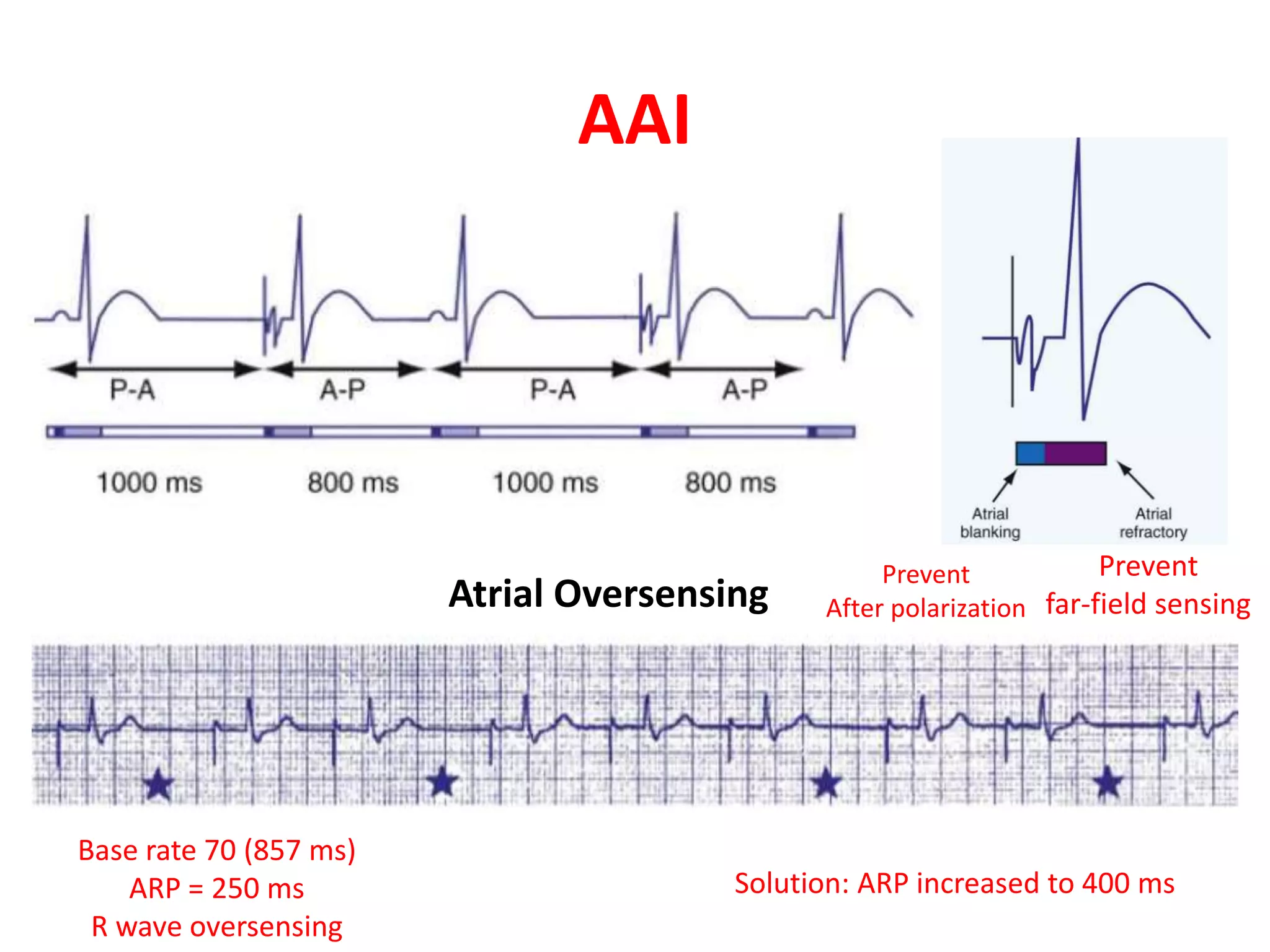 Understanding pacemakers | PPTX