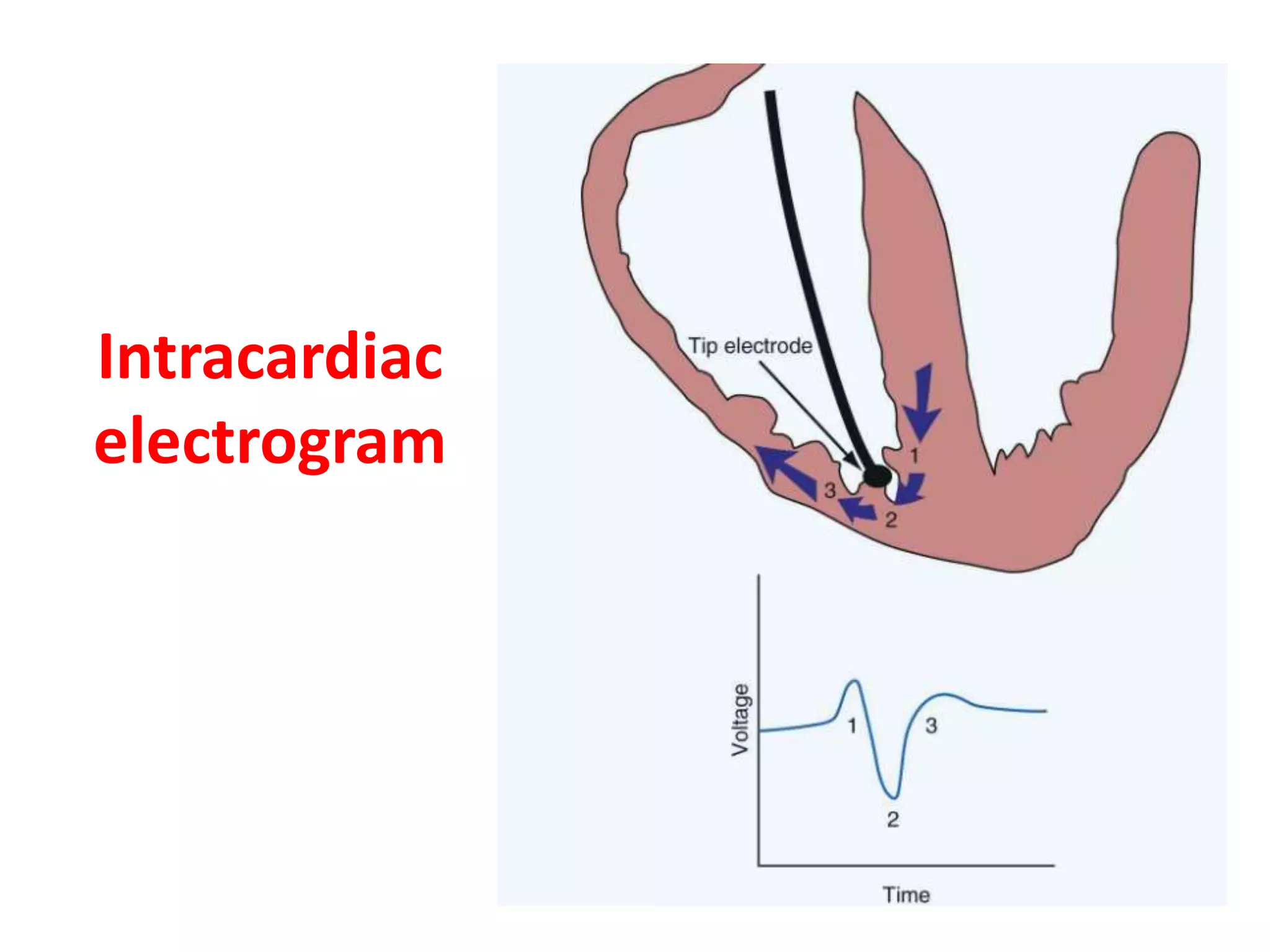 Understanding pacemakers | PPTX