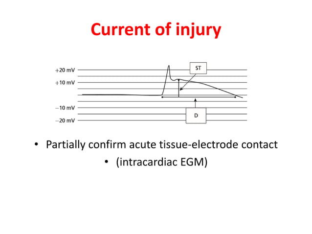 Understanding pacemakers | PPTX