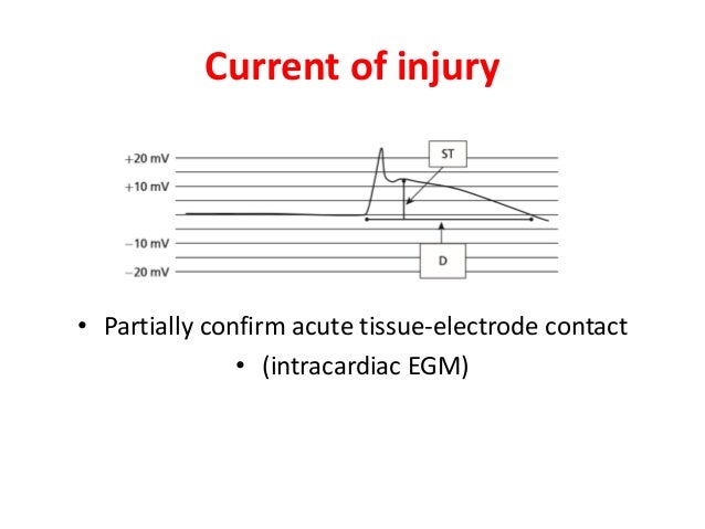Understanding pacemakers