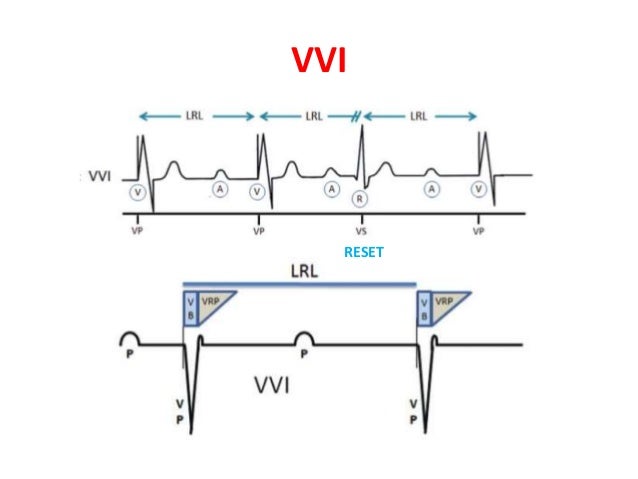 Understanding pacemakers