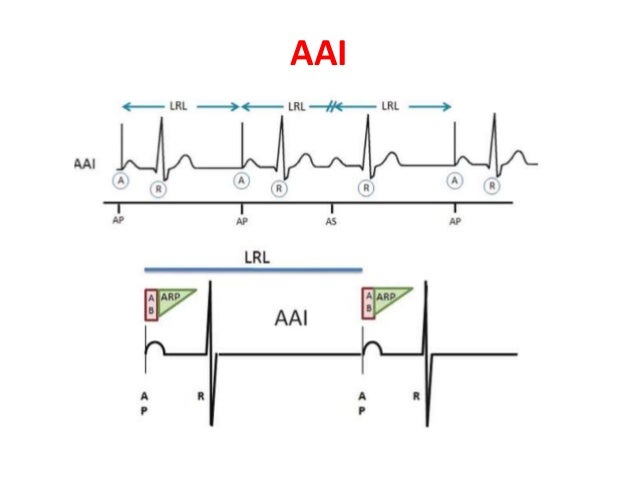 Understanding pacemakers