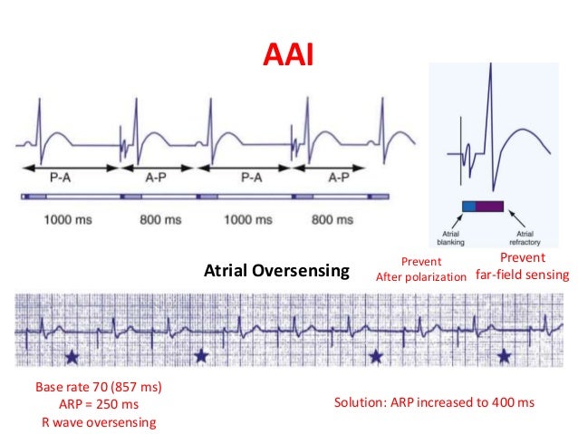 Understanding pacemakers