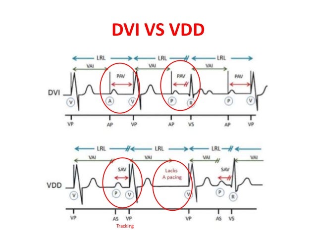 Understanding pacemakers