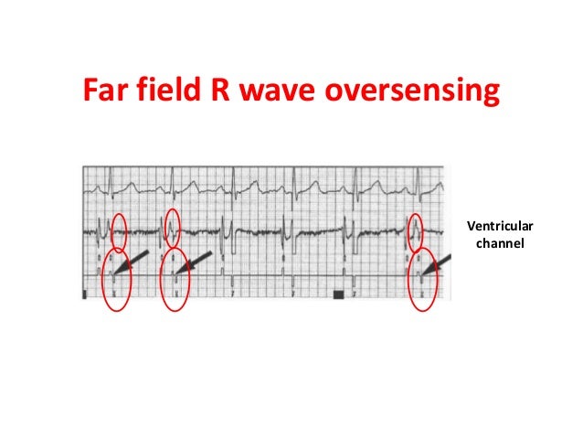 Understanding pacemakers