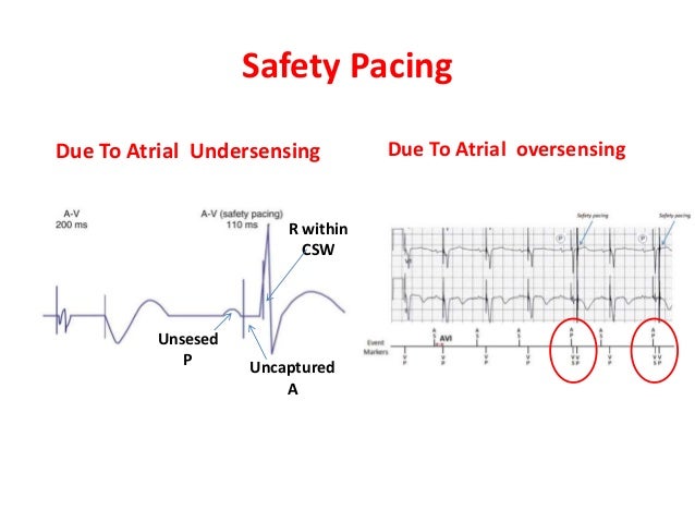 Understanding pacemakers