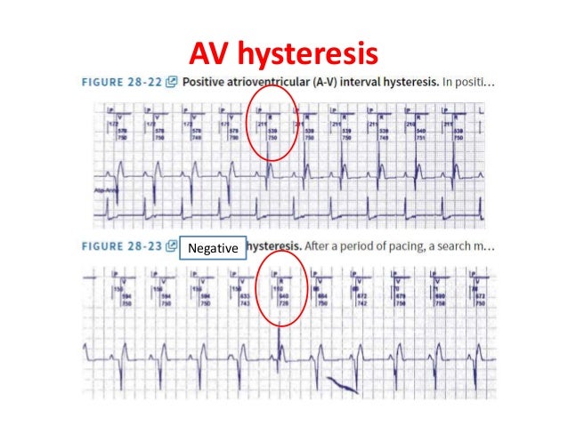 Understanding Pacemakers