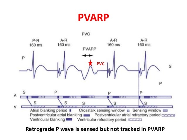 Understanding pacemakers