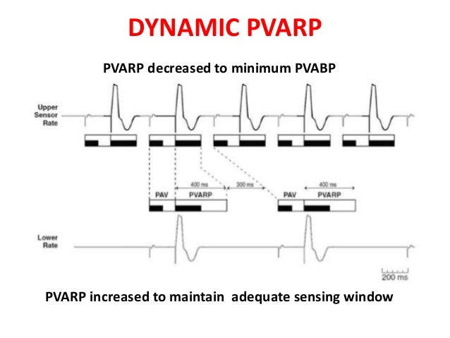 Understanding pacemakers