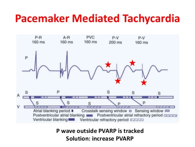 Understanding Pacemakers