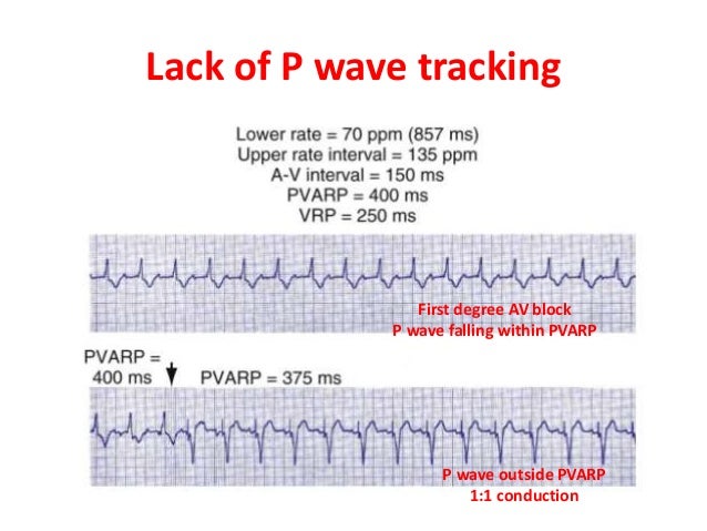 Understanding pacemakers
