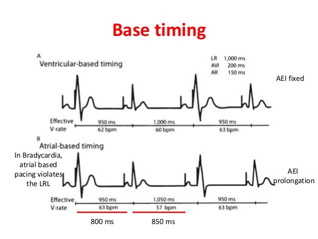 Understanding pacemakers