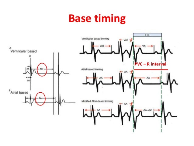 Understanding pacemakers