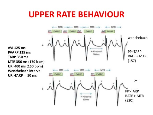 Understanding pacemakers