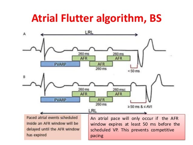 Understanding pacemakers
