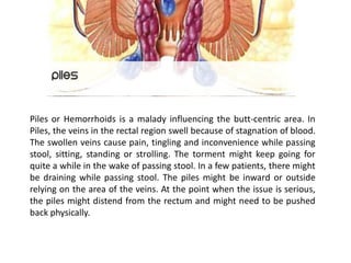 Understanding piles (or) hemorrhoids. | PDF