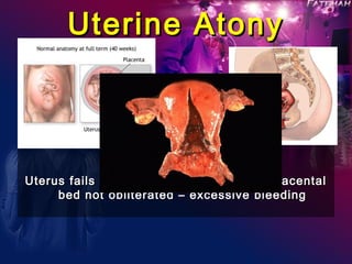 Understanding pph | PPT