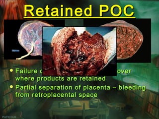 Understanding pph | PPT