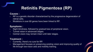 Understanding Retina Diseases | PPTX