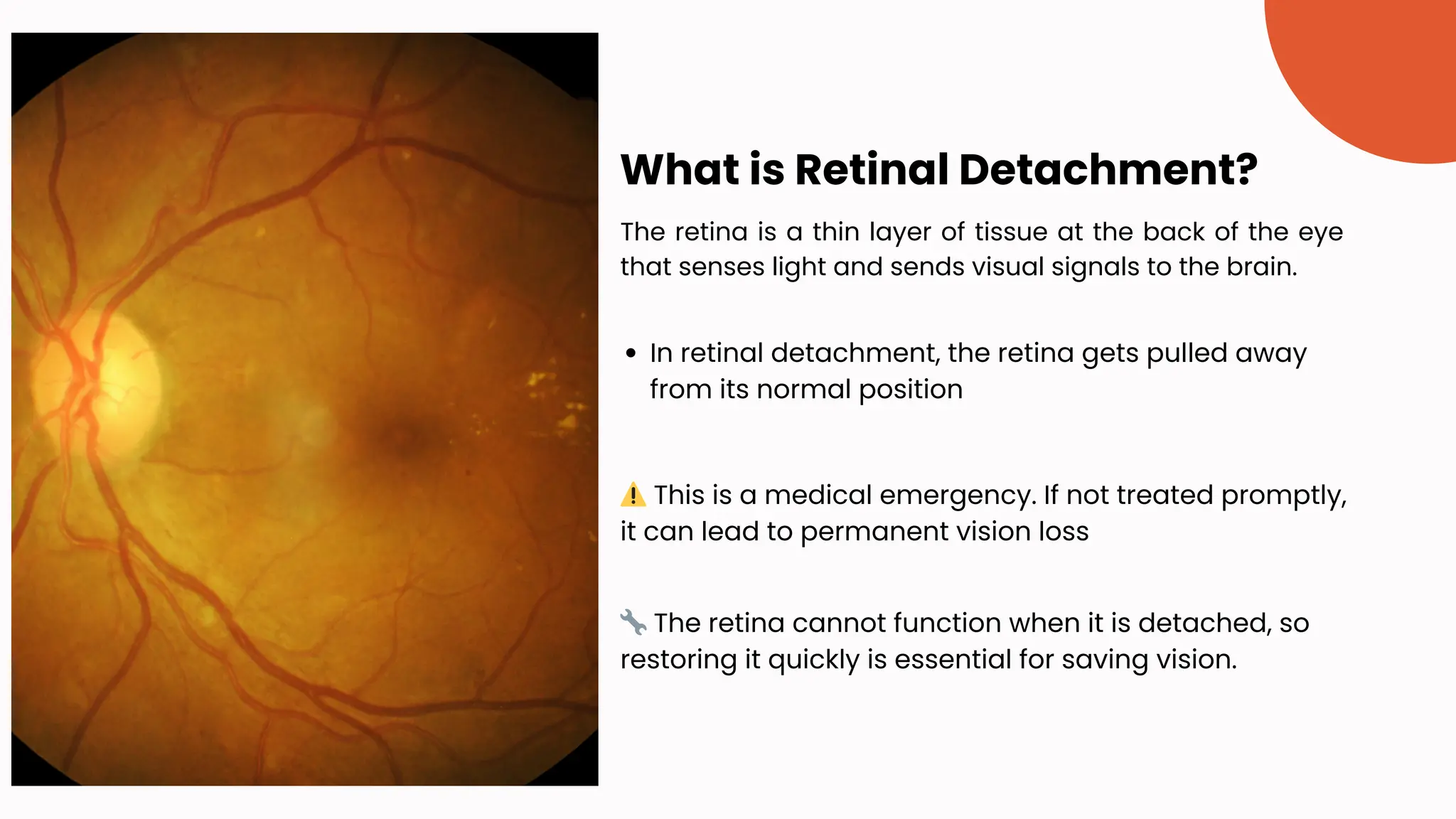 Understanding Retinal Detachment: Causes, Symptoms & Urgency | PDF
