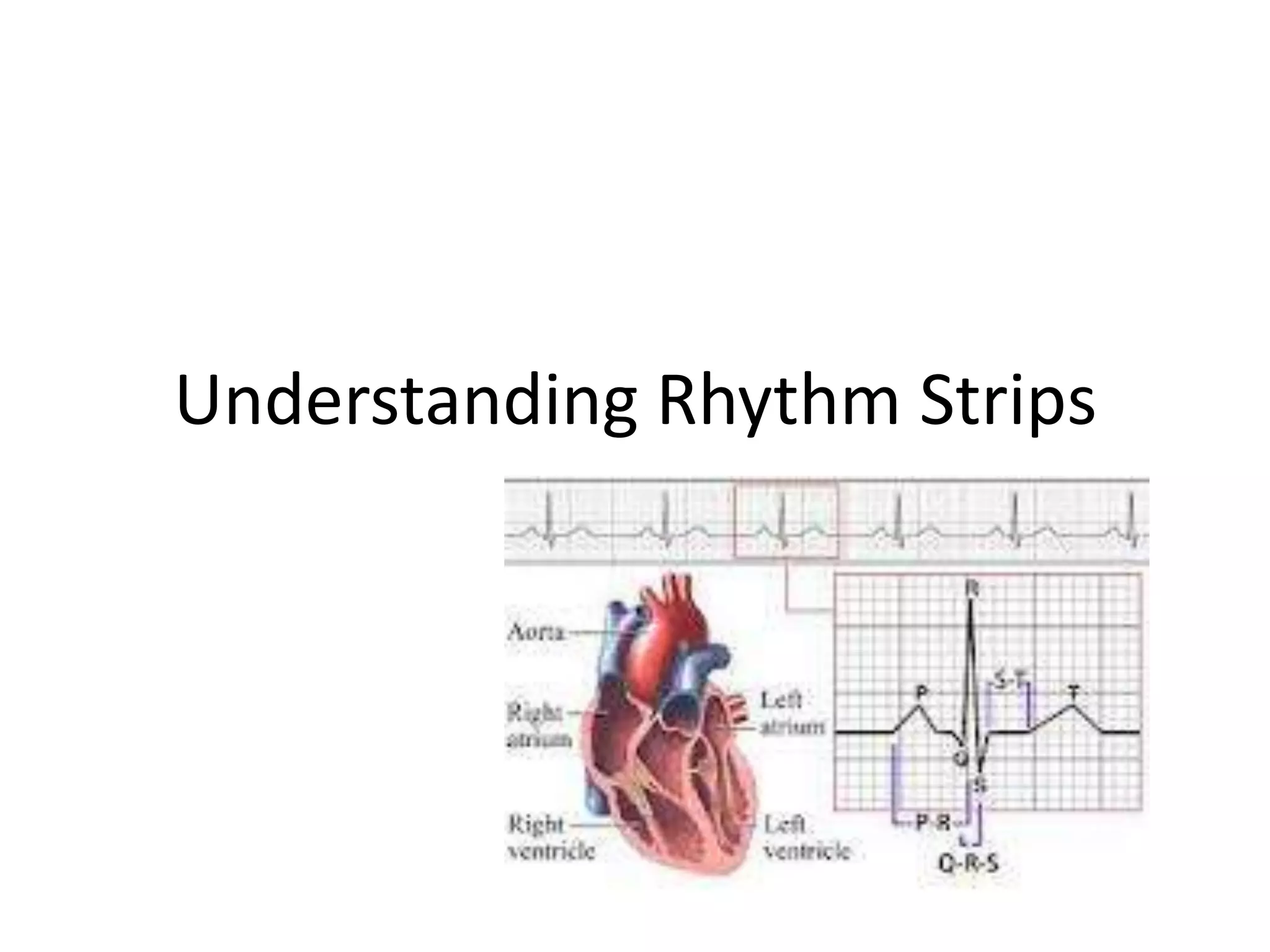 Understanding rhythm strips | PPTX