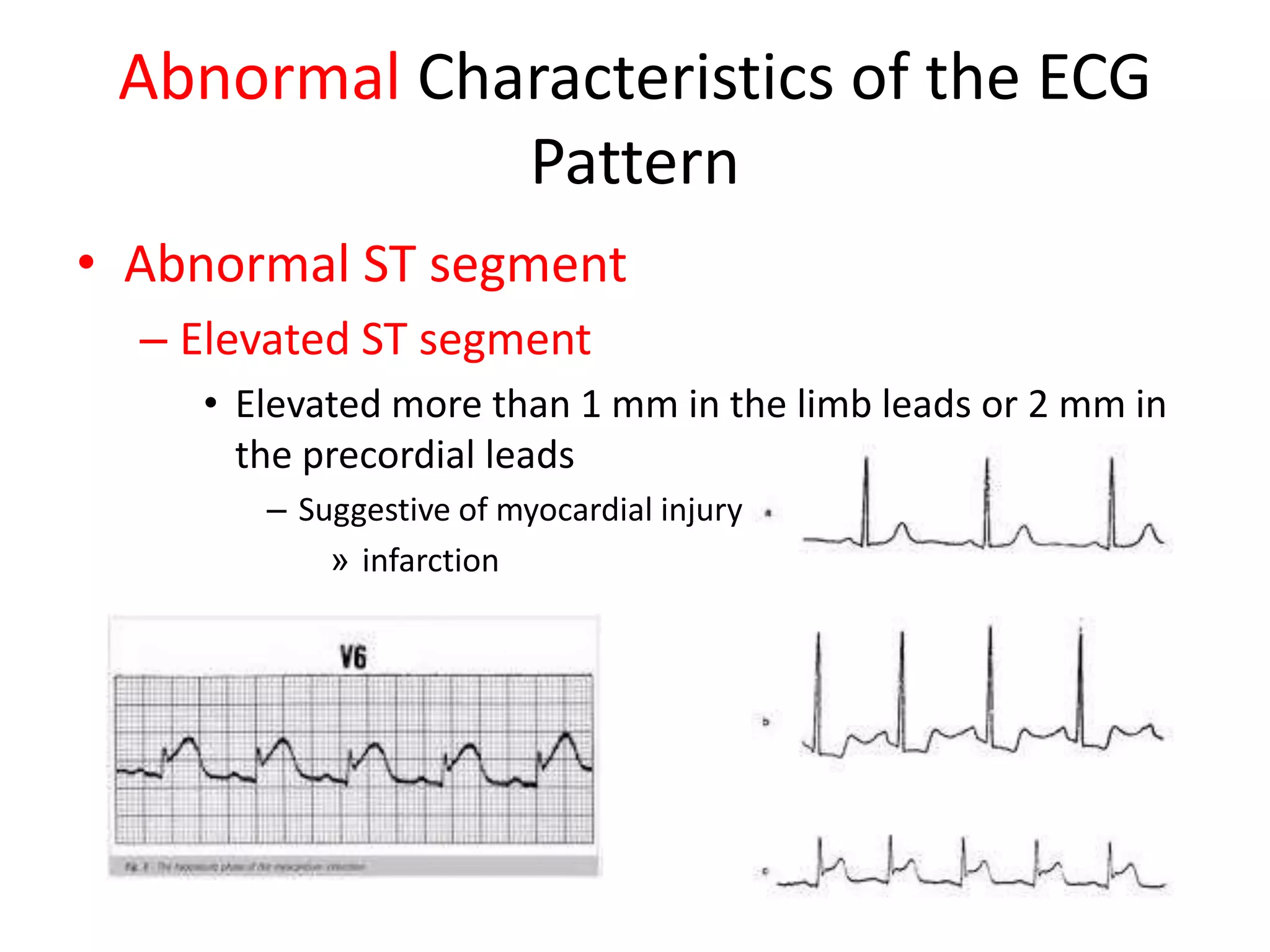 Understanding rhythm strips | PPTX