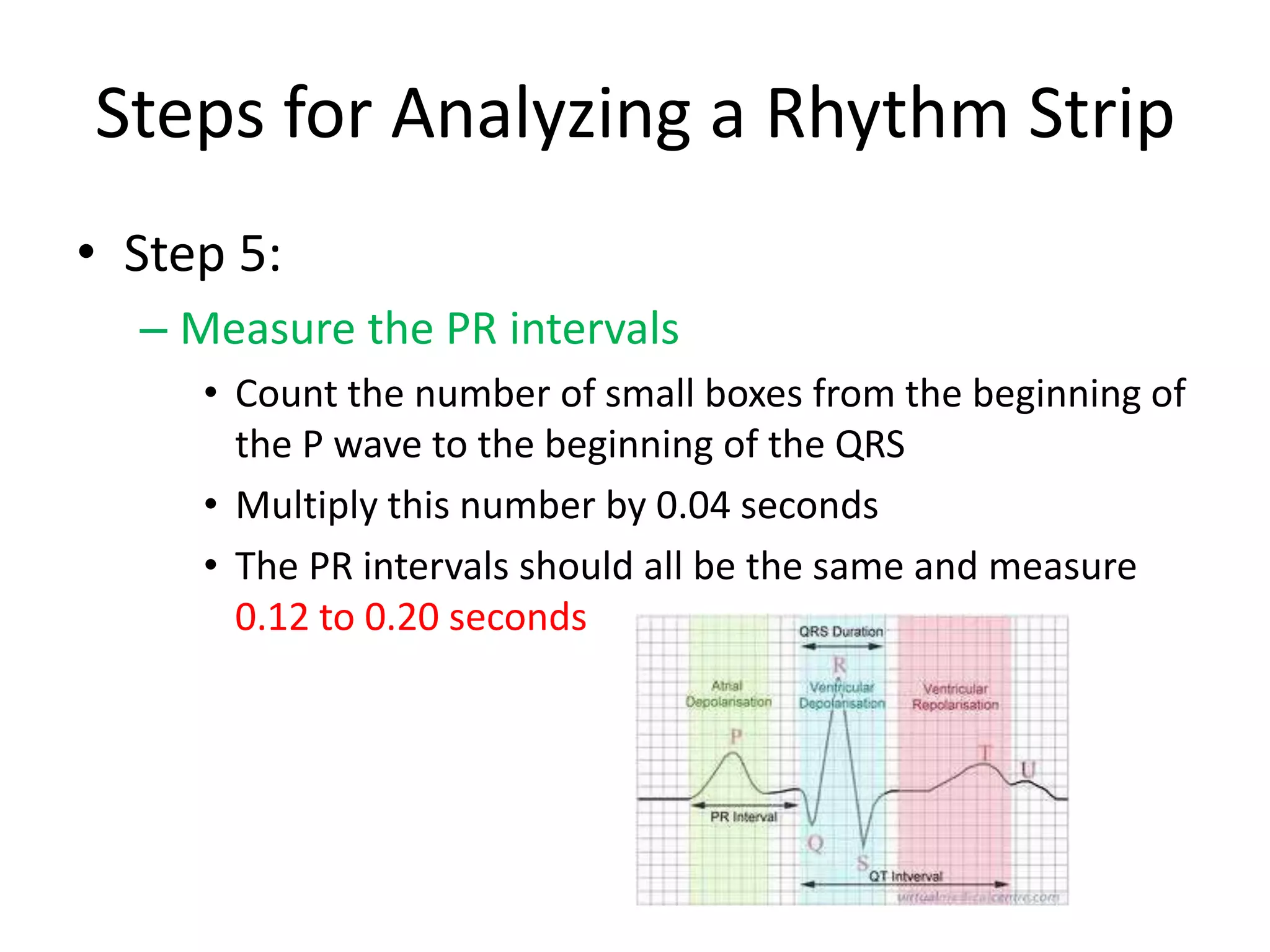 Understanding rhythm strips | PPTX