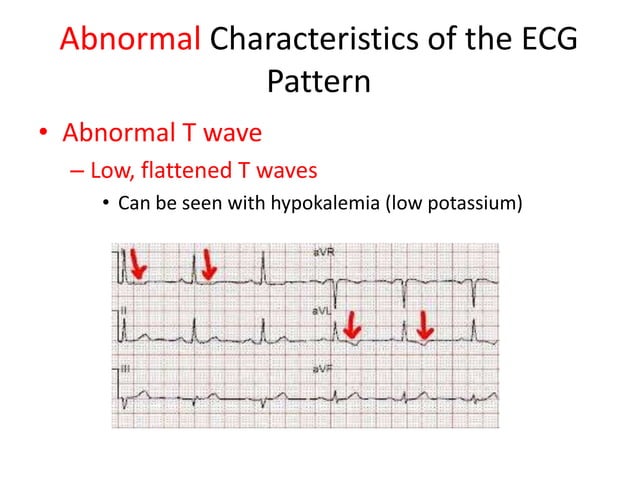 Understanding rhythm strips | PPTX | Heart and Cardiovascular Diseases ...