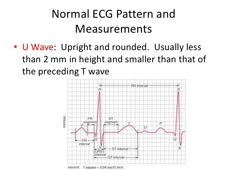 Understanding rhythm strips