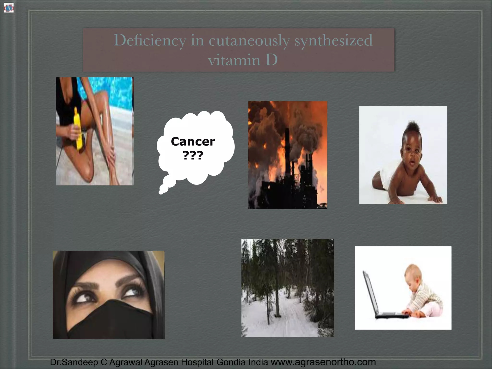 Understanding rickets types,diagnosis,prevention & treatment dr.sandeep ...