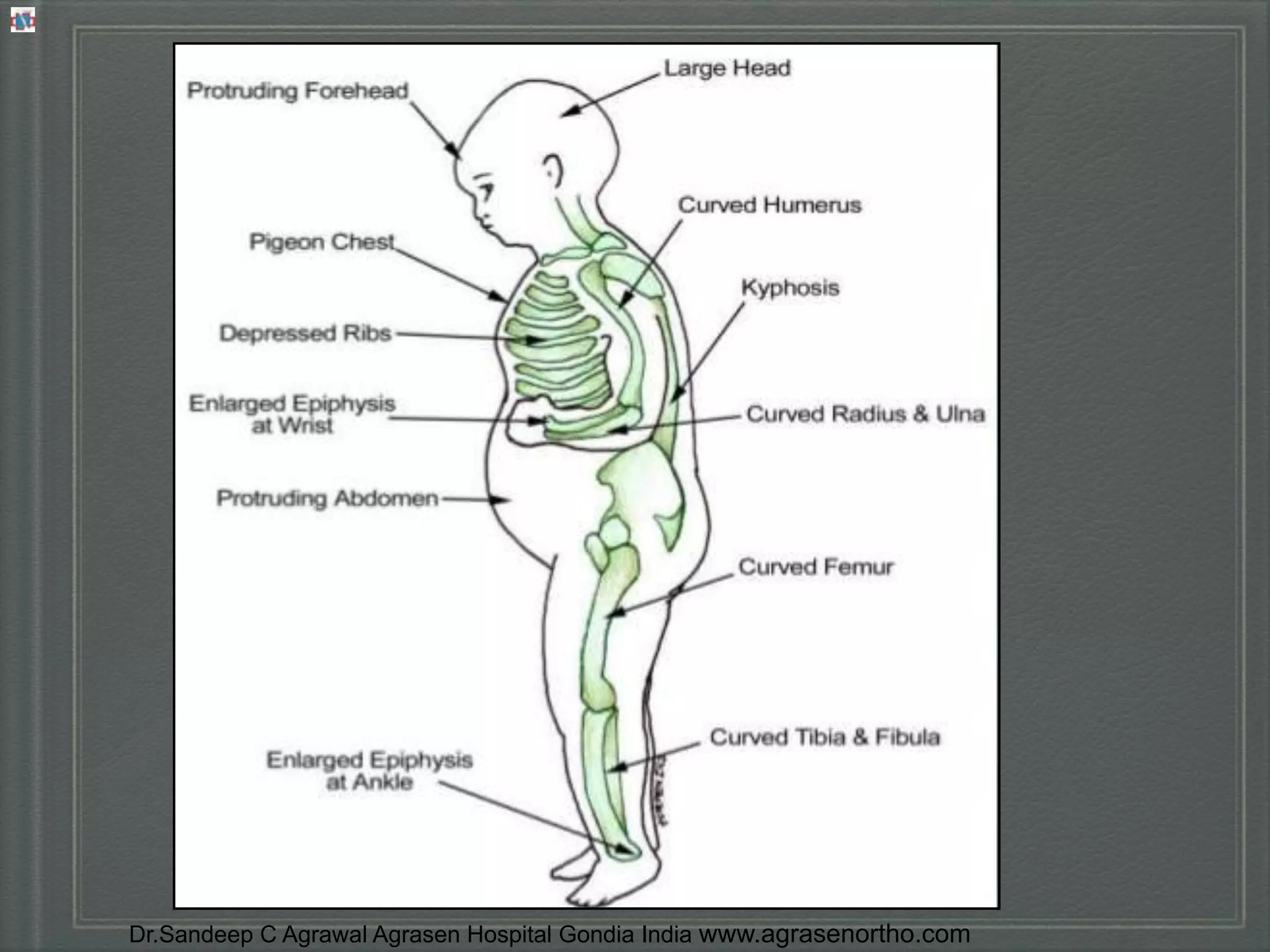 Understanding rickets types,diagnosis,prevention & treatment dr.sandeep ...