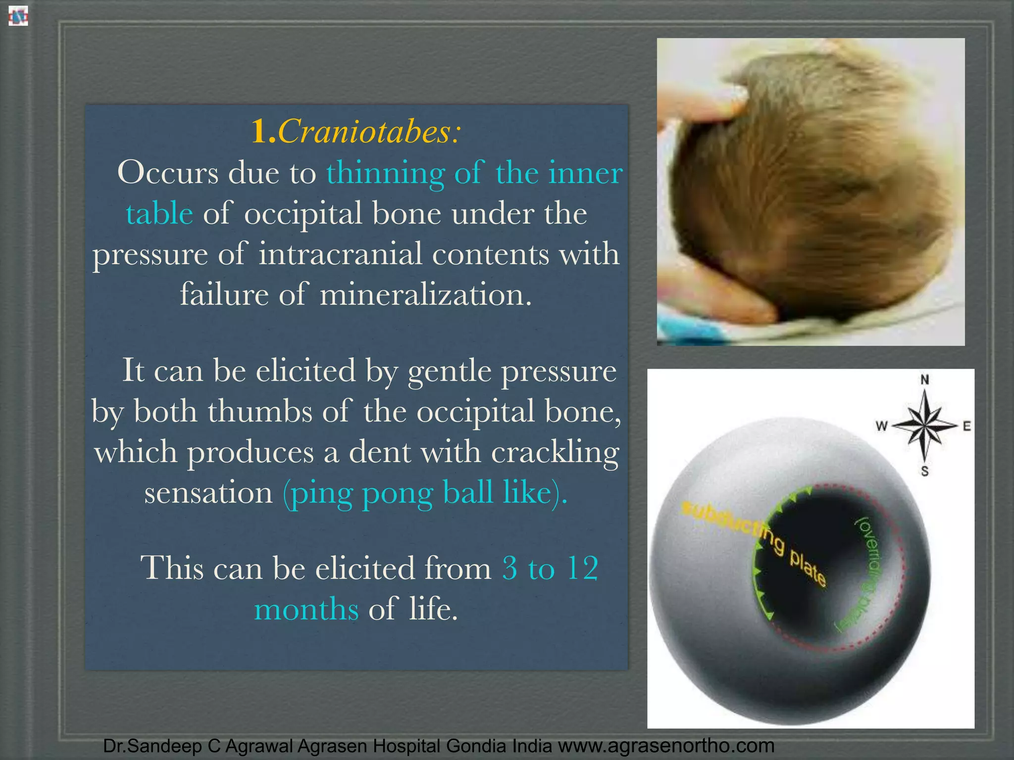 Understanding rickets types,diagnosis,prevention & treatment dr.sandeep ...