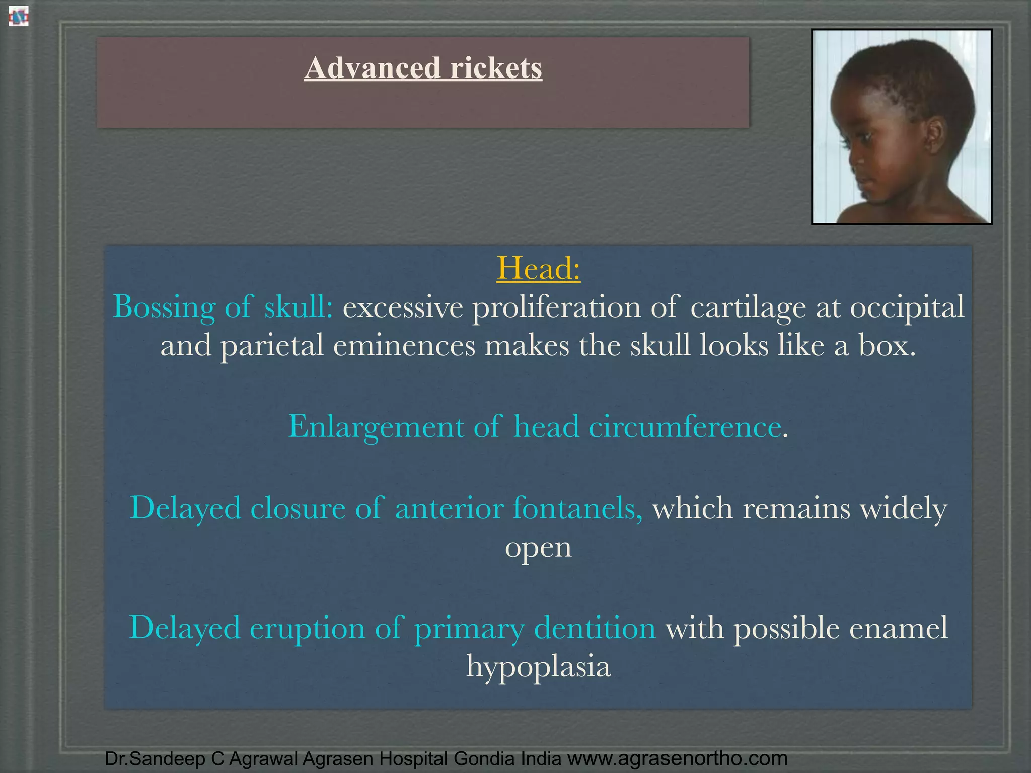 Understanding rickets types,diagnosis,prevention & treatment dr.sandeep ...