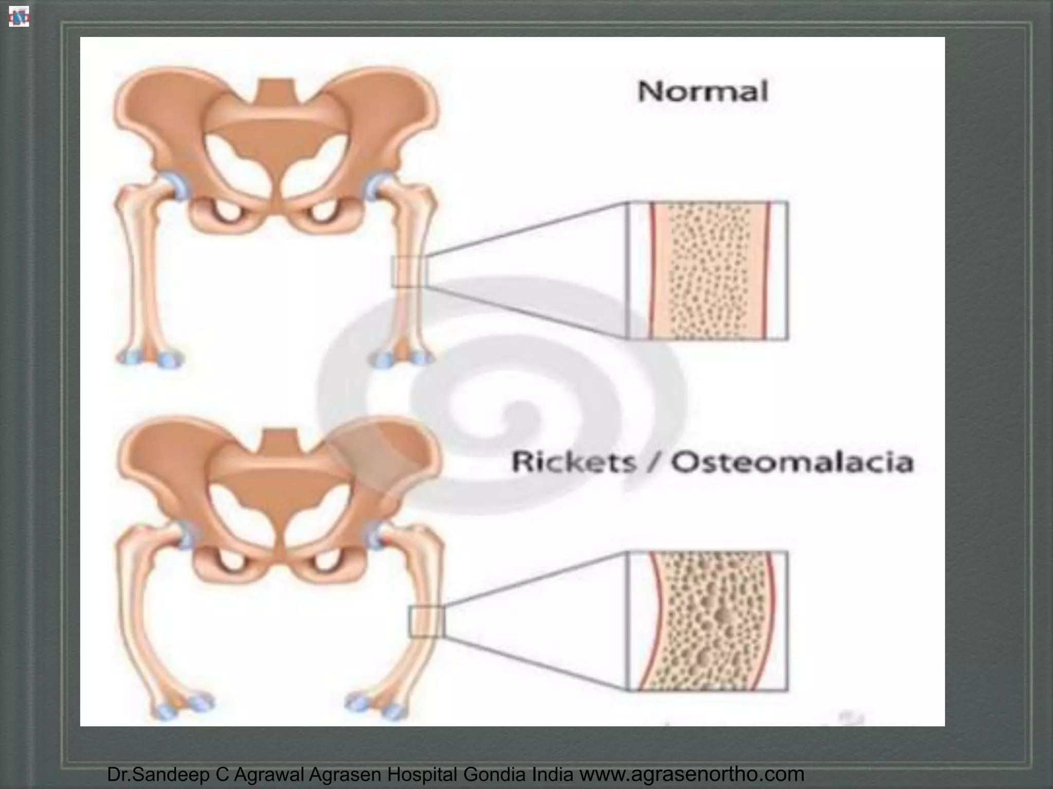 Understanding rickets types,diagnosis,prevention & treatment dr.sandeep ...