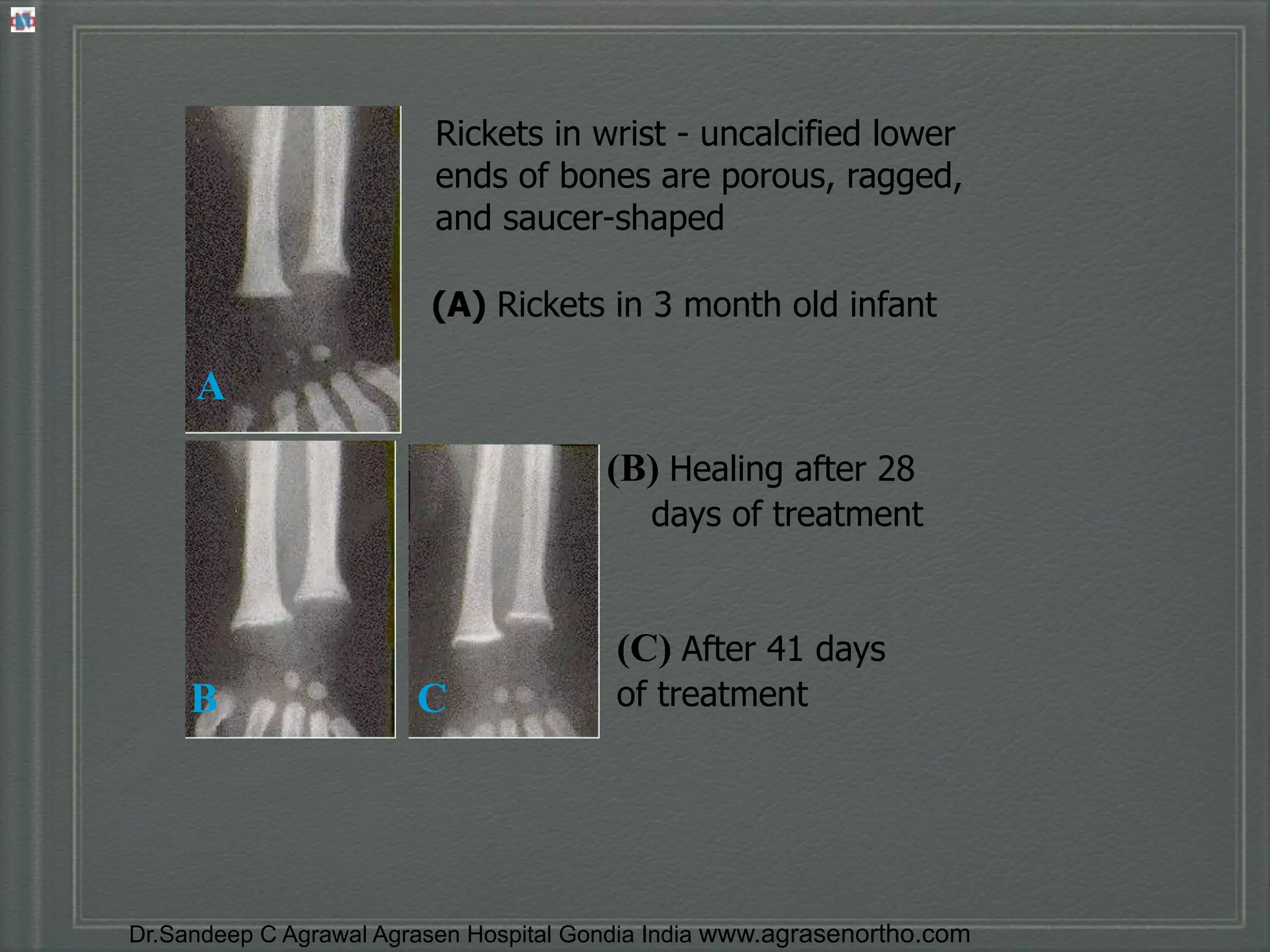 Understanding rickets types,diagnosis,prevention & treatment dr.sandeep ...