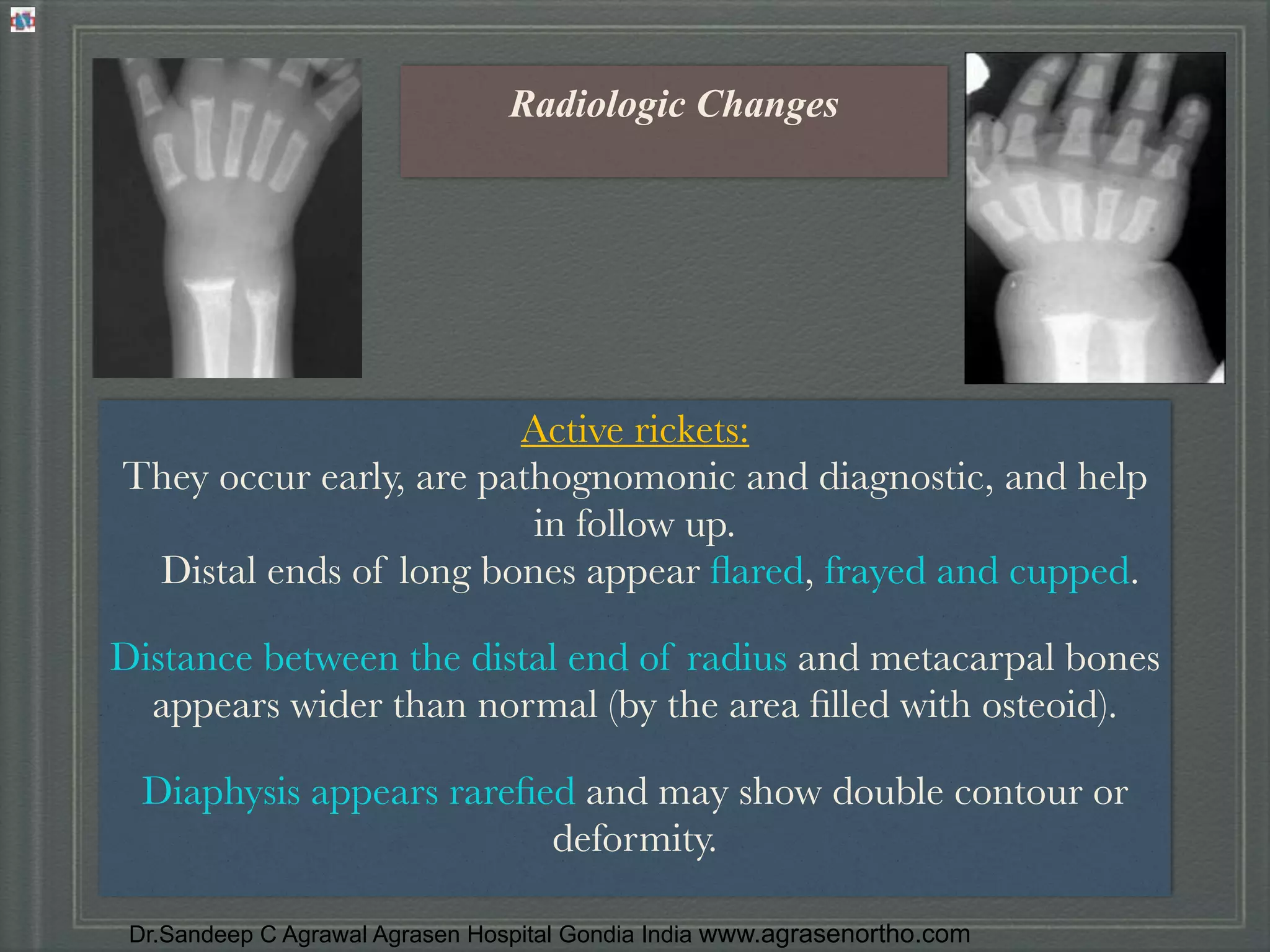 Understanding rickets types,diagnosis,prevention & treatment dr.sandeep ...