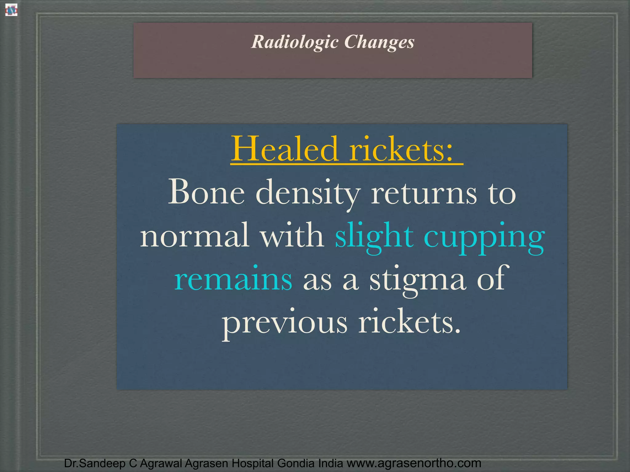 Understanding rickets types,diagnosis,prevention & treatment dr.sandeep ...