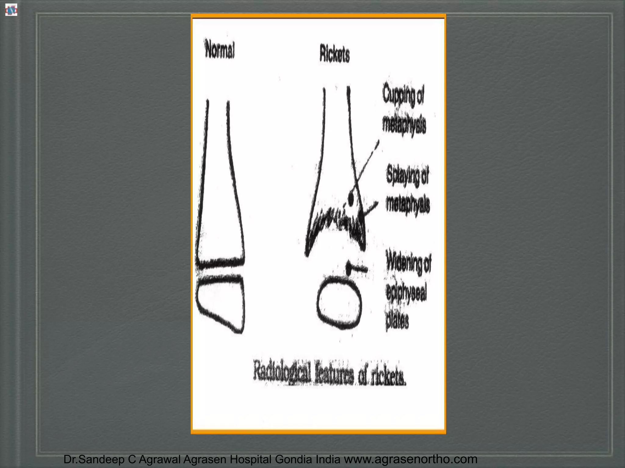 Understanding rickets types,diagnosis,prevention & treatment dr.sandeep ...