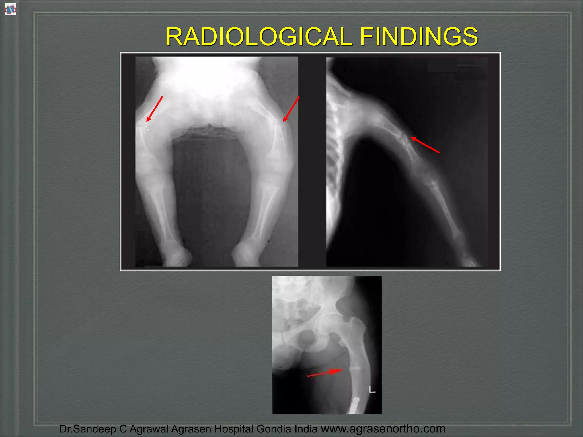 Understanding rickets types,diagnosis,prevention & treatment dr.sandeep ...