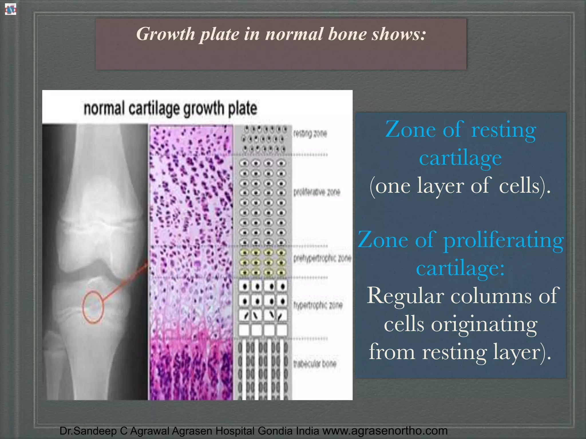 Understanding rickets types,diagnosis,prevention & treatment dr.sandeep ...