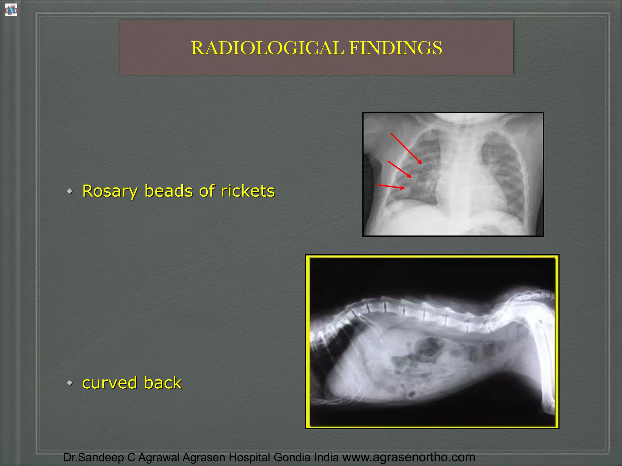 Understanding rickets types,diagnosis,prevention & treatment dr.sandeep ...