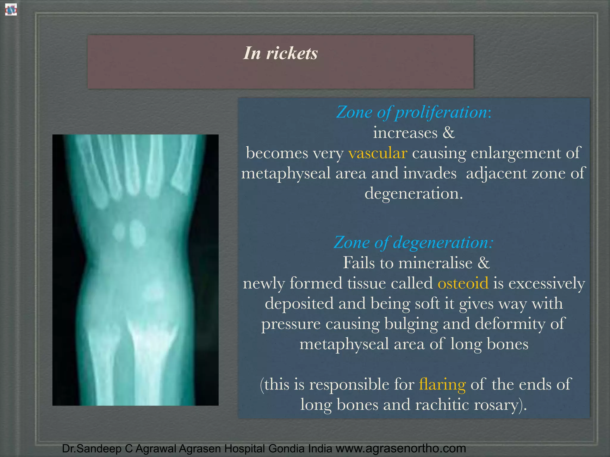 Understanding rickets types,diagnosis,prevention & treatment dr.sandeep ...