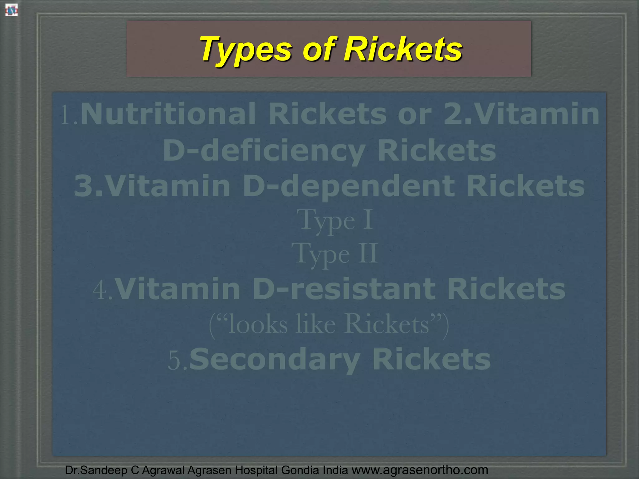 Understanding rickets types,diagnosis,prevention & treatment dr.sandeep ...