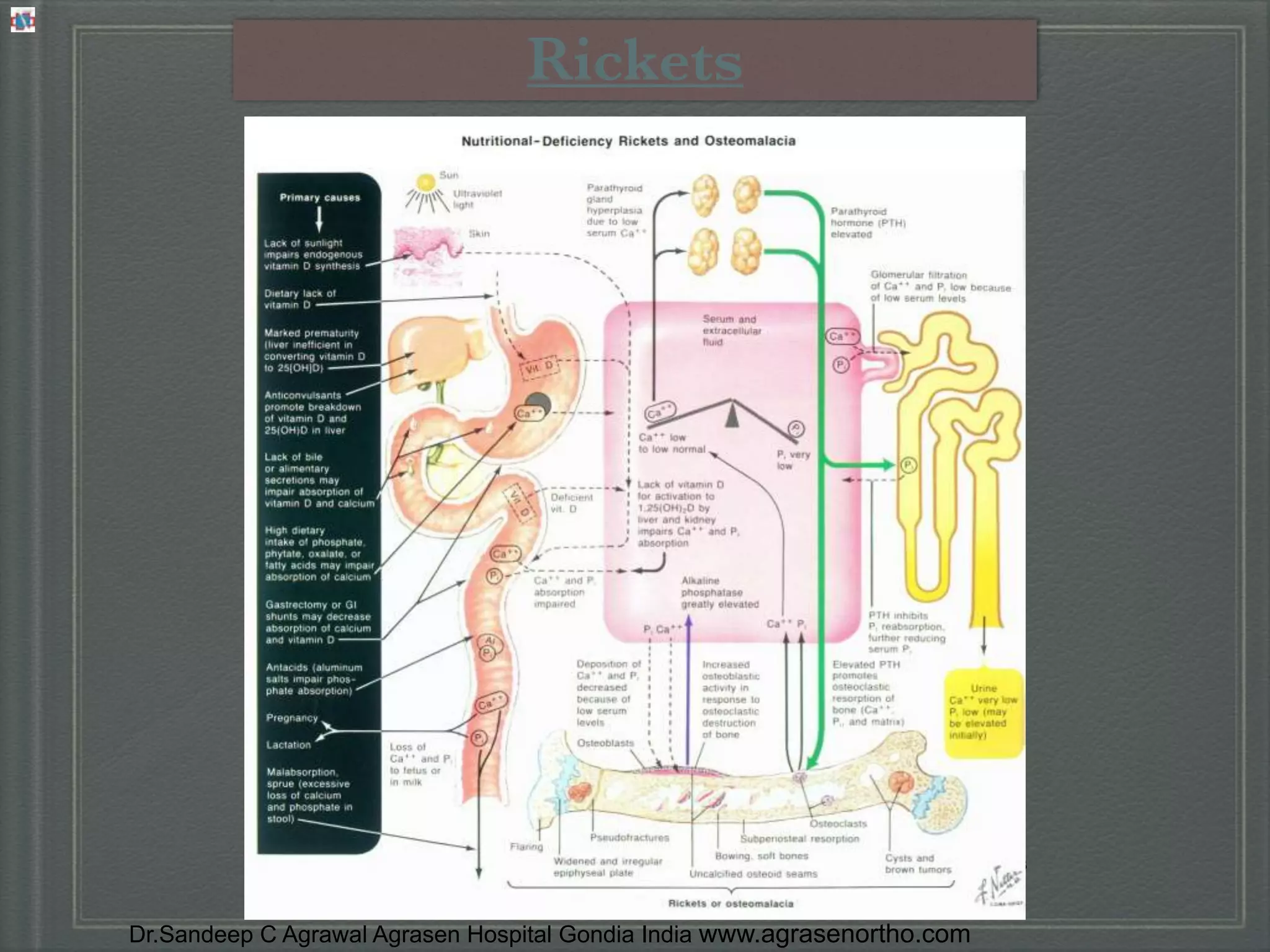 Understanding rickets types,diagnosis,prevention & treatment dr.sandeep ...