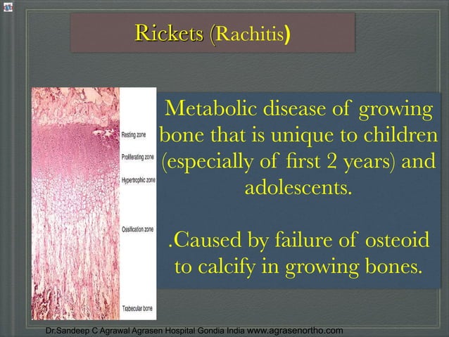 Understanding rickets types,diagnosis,prevention & treatment dr.sandeep ...