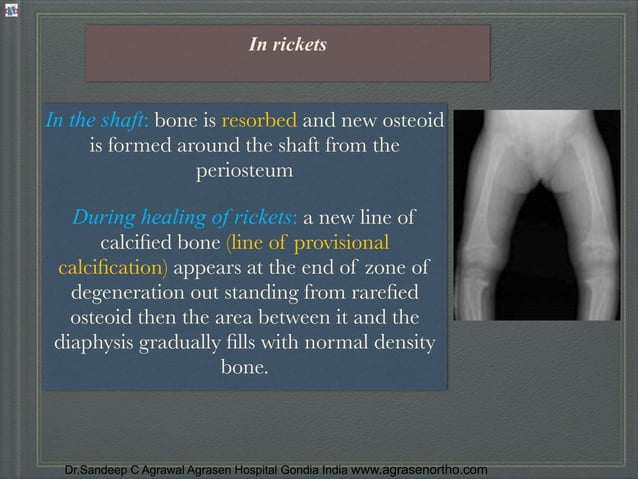 Understanding rickets types,diagnosis,prevention & treatment dr.sandeep ...