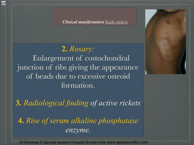 Understanding rickets types,diagnosis,prevention & treatment dr.sandeep ...