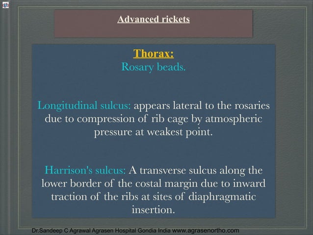 Understanding rickets types,diagnosis,prevention & treatment dr.sandeep ...