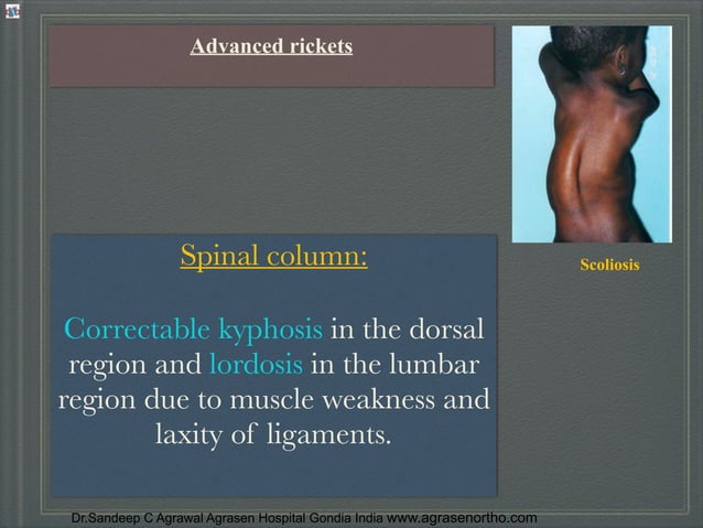 Understanding rickets types,diagnosis,prevention & treatment dr.sandeep ...