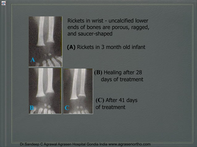 Understanding rickets types,diagnosis,prevention & treatment dr.sandeep ...